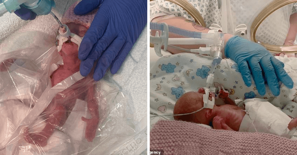 Doctors Weren't Sure 1-Pound Baby Would Survive - So They Did The ...