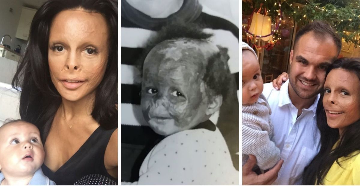 Woman Learns The Life-changing Truth Behind Her Burn Scars - Goalcast